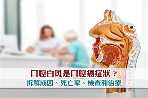 口腔白斑是口腔癌症狀拆解成因死亡率檢查和治療 ESDlife健康網購
