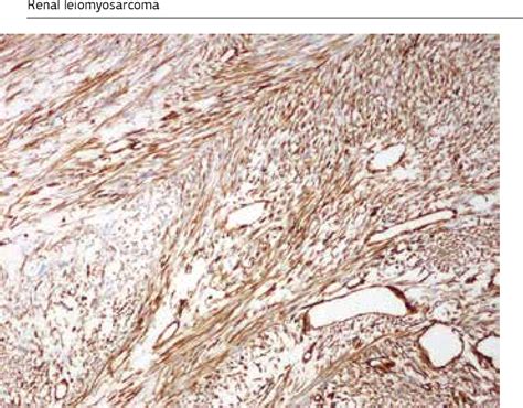 Figure 2 From Renal Leiomyosarcoma A Rare Entity Semantic Scholar