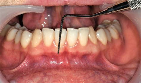 Measurement Of Width Of Keratinized Gingiva Download Scientific Diagram