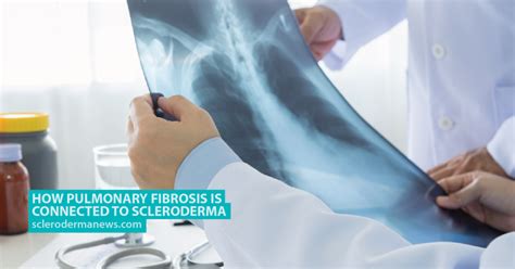 How Pulmonary Fibrosis Is Connected To Scleroderma Scleroderma News