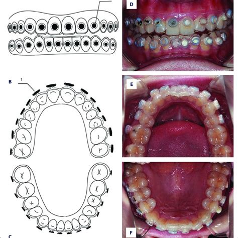 Schematic Of The Model And Intraoral Photographs A Front View Of The