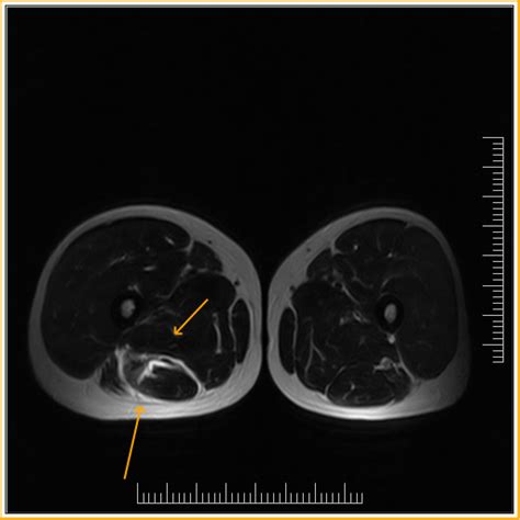 Biceps Femoris Tear Mri Sumers Radiology Blog
