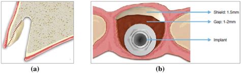 Implant Socket Shield Tự Học Rhm