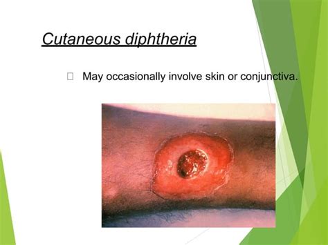 Diphtheria Pptx