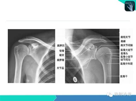 肩关节常见疾病的MRI表现 好医术早读文章 好医术 赋能医生守护生命