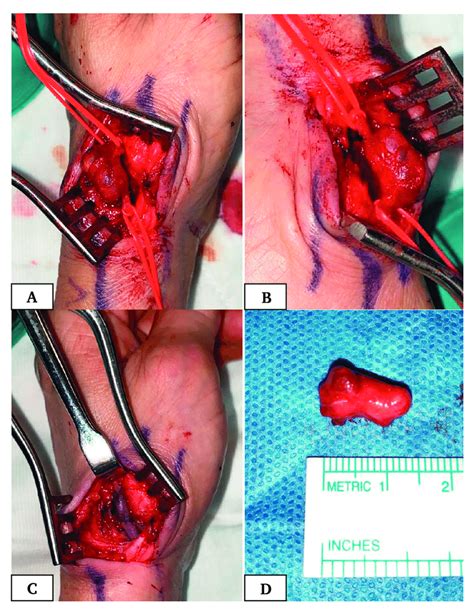 Intra Operative Photographs Showing Ab The Radial Artery Aneurysm