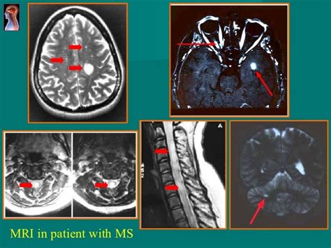 Multiple Sclerosis