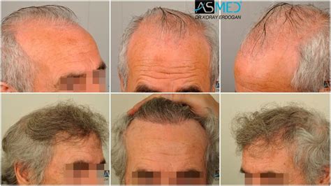 Results Norwood 6 Asmed Hair Transplant