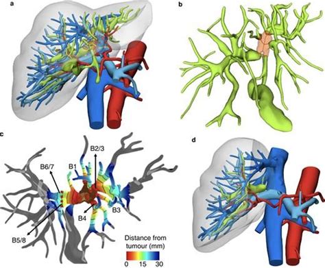 Medics On Linkedin Perihilar Cholangiocarcinoma Three Dimensional Modelling Algorithm To…