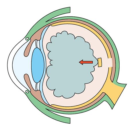 黄斑円孔の症状見え方は原因や治療手術よし眼科クリニック