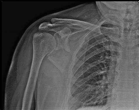 Figure 4 From Scapular Spine Stress Fracture Followin