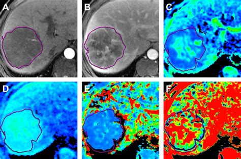 Intrahepatic Cholangiocarcinoma In The Setting Of Hbv Related Cirrhosis Differentiation With