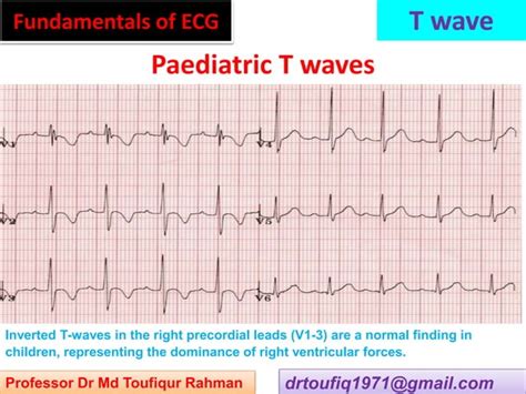 Approach To A Patient With T Wave Abnormality In Ecg