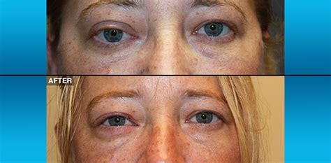 Orbital Decompression Northwest Eyelid Orbital Specialists PS NEOS Surgery Center Spokane