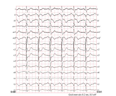 The Ptb Diagnostic Ecg Database