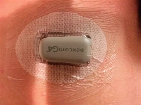 I Am A Type 1 Diabetic Warrior How I Tape Down My Dexcom G4 To Get More Than 14 Days Of Use