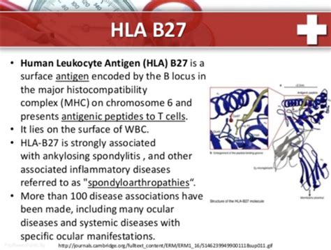 Lecture 169 Spondyloarthropathies Ankylosing Spondylitis Psoriatic