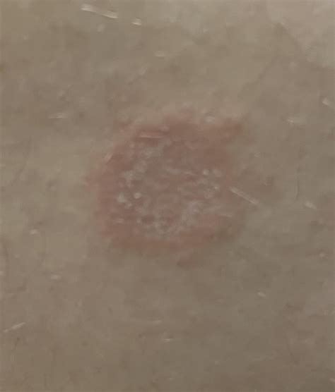 Ringworm T T Doesnt Look Gross Just Spoiler Ing In Case R Dermatologyquestions
