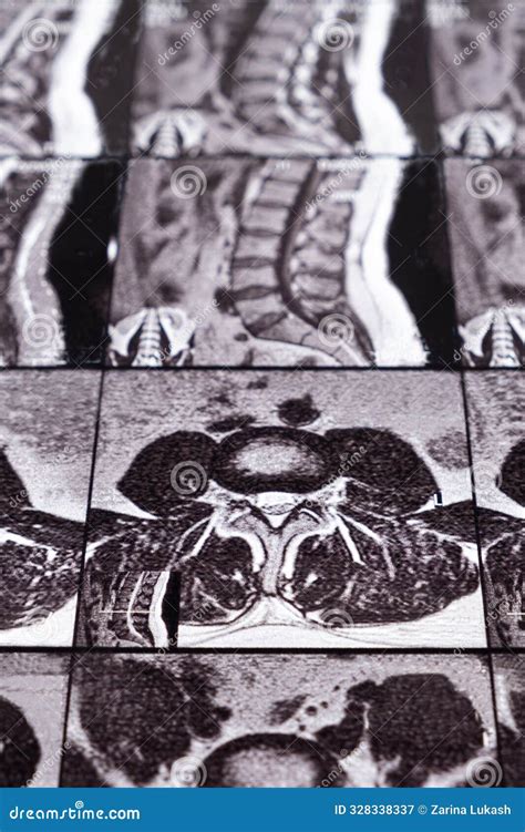 Mri Of A Patient With Intervertebral Disc Protrusion And Osteochondrosis Of The Thoracic Spine