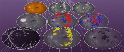 DREAM Diabetic Retinopathy Analysis Using Machine Learning Journal Of Biomedical And Health
