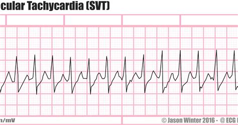 Icd 10 Cm Code For Wide Complex Tachycardia