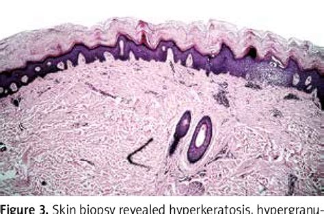 Figure 3 From Dermoscopy Of Frictional Asymptomatic Darkening Of The Extensor Surfaces