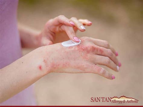 How Is Eczema Diagnosed And What To Expect When You See An Eczema Expert San Tan Allergy And Asthma