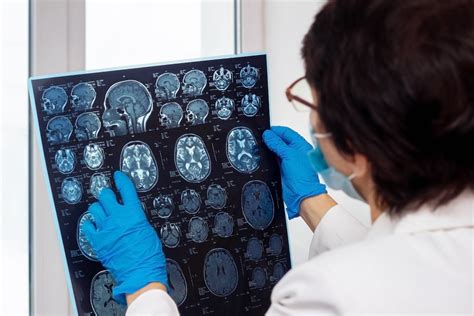 Epilepsia qué es tipos síntomas y tratamiento Tua Saúde