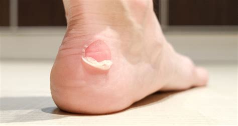 Blister Like Sore On Bottom Of Foot Hotsell