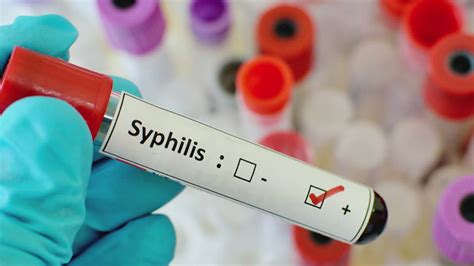 Rising Syphilis Cases In Nueces County Prompt Urgent Focus