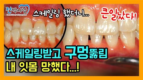 4 2 잇몸사이의 틈 잇몸이 내려앉음 후 스케일링 무섭네요 부작용 생길 수도 있어요 YouTube