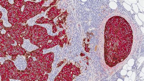 Novel Her2 Assay To Predict Her2 Breast Cancer Tx Response