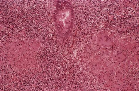 Endometrial Tuberculosis Stock Image C015 6906 Science Photo Library