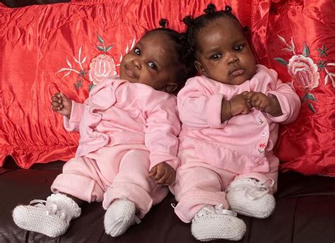 Conjoined Twins Who Survived Uks First Spine Separation Surgery Say