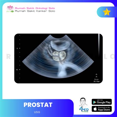 Usg Prostat