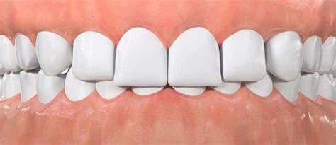 Deep Bite Causes Effects And Treatment Options