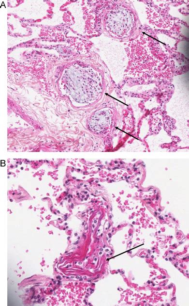 Amniotic Fluid Embolism After Uterine Artery Embolization For Uterine