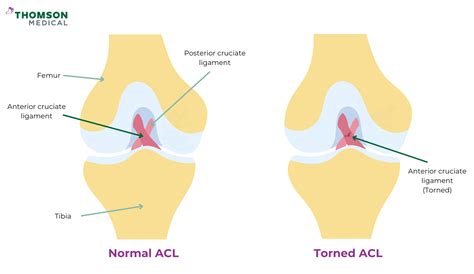 Acl Tear And Injuries Causes Symptoms And Recovery Thomson Medical