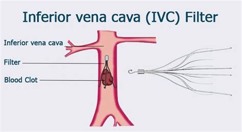 Ivc Filter Inferior Vena Cava Gastonia