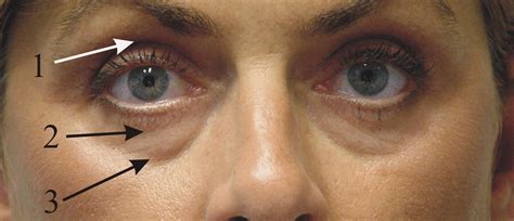 Surco Malar Blefaroplastia