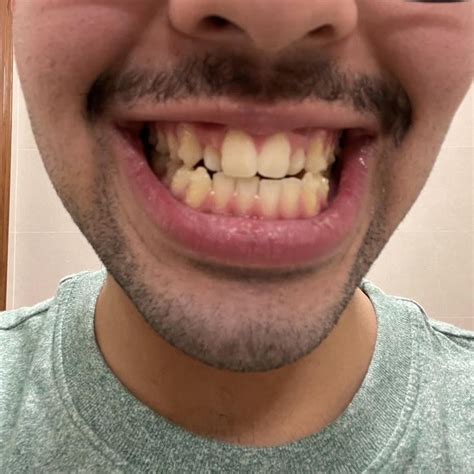 My Invisalign Journey 😁😁 R Invisalign