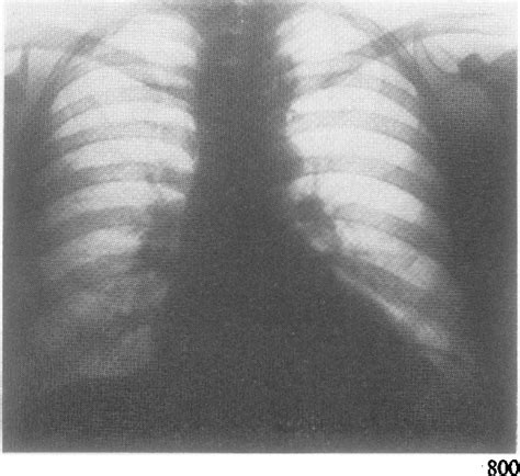 Figure 1 From Mediastinal Thoracic Duct Cyst Semantic Scholar