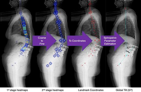 Deep Learning Approach For Automatic Landmark Detection In Whole Spine