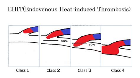 レーザー治療後の合併症 静脈瘤日帰りレーザー治療専門 こうち静脈ケアクリニック