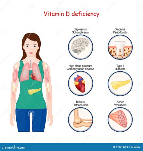 Deficiencia De Vitamina D Cuerpo Humano Y Cierre De Organos Con Efectos De Deficiencia Eroppa