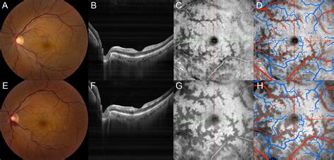 Paracentral Acute Middle Maculopathy And The Ischemic Cascade Towards