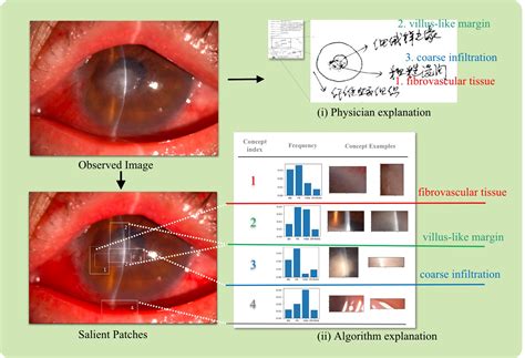 Concept Based Explanation For Fine Grained Images And Its Application In Infectious Keratitis