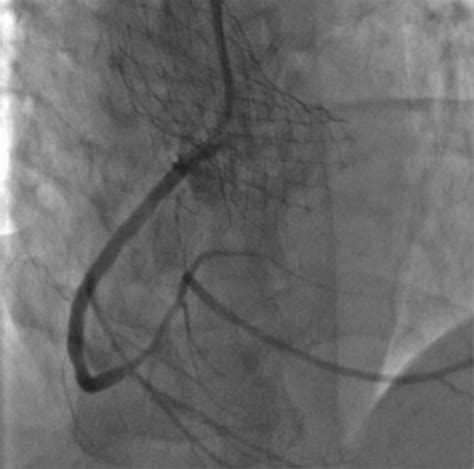 Final Angiographic Results With A Timi Iii Flow Download Scientific
