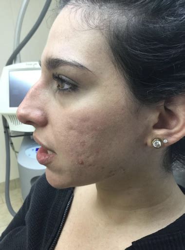 Lumenis Resurfx Facial Plastic Surgeon