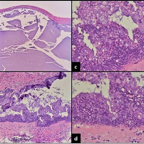 A Dilated Appendix Filled With Mucinous Material And Mostly Devoid Of